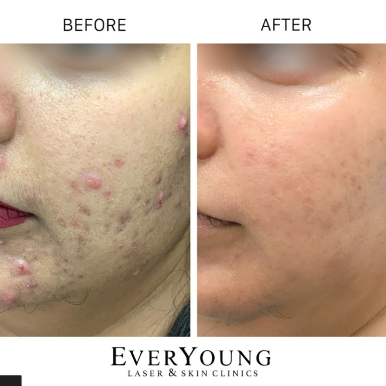 Choosing the Right Acne Scar Treatment: A Comprehensive Guide