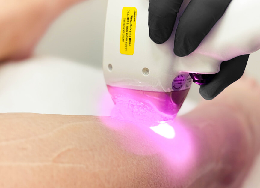 Harmony® XL Pro Dye VL Laser | EverYoung Skin Clinic